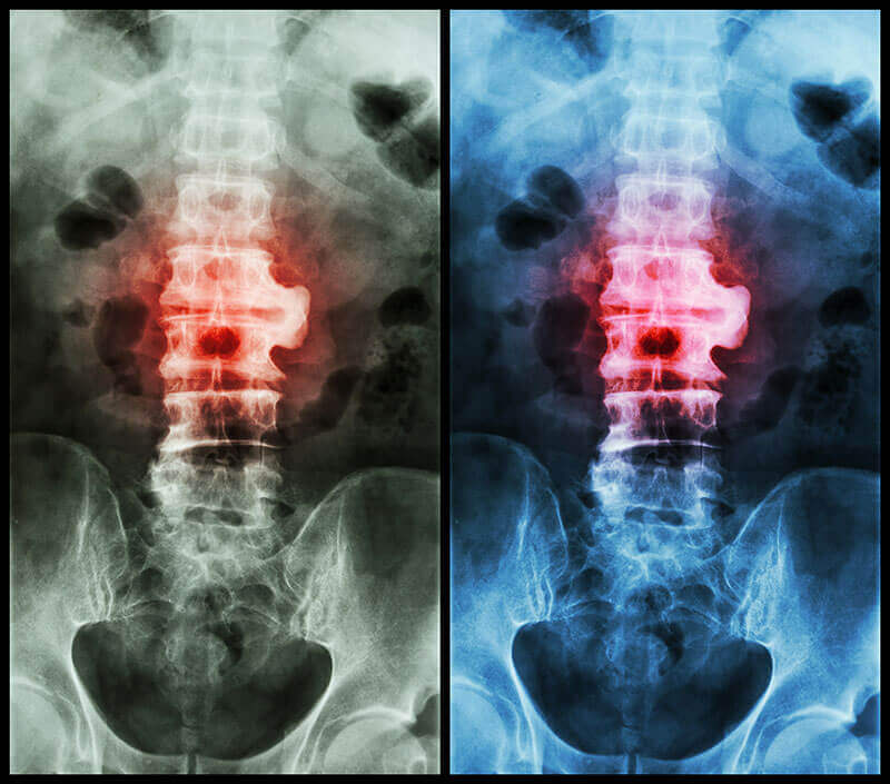 Spondylosis: causes, symptoms, treatment | CENTROKINETIC