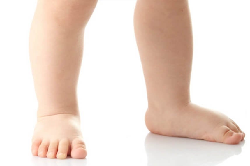 Calcaneus Osteotomies In The Flat Foot Valg | CENTROKINETIC