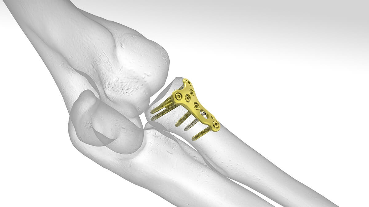 Oats Technique For Osteocartilaginal Defects Of The Ankle | CENTROKINETIC