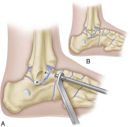Bostrom Technique For Reconstruction Of The Anterior Talo-Fibular ...