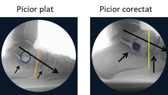Valg Flat Foot Correction Technique With Hyprocure | CENTROKINETIC