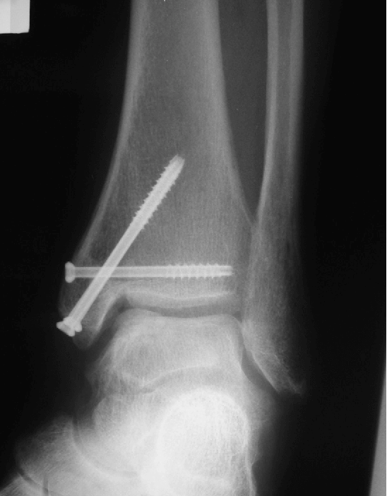 Oats Technique For Osteocartilaginal Defects Of The Ankle | CENTROKINETIC