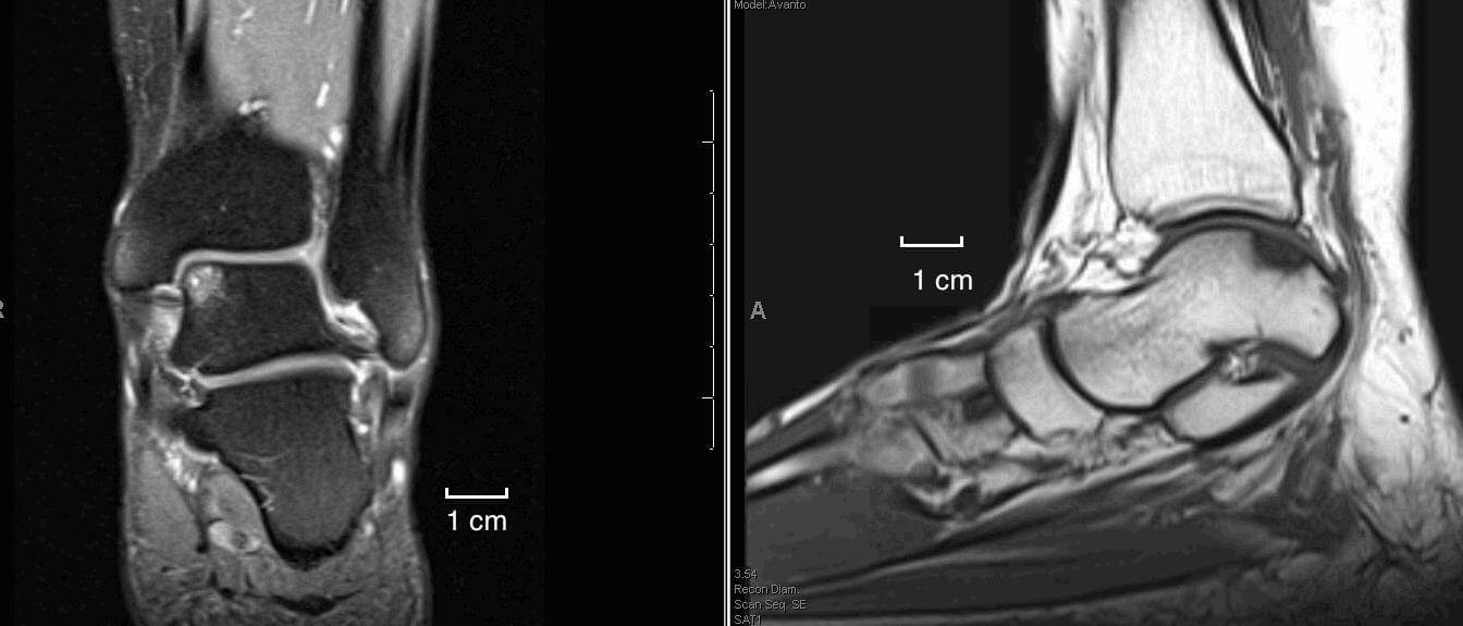 Reconstruction Of Talar Articular Cartilage | CENTROKINETIC