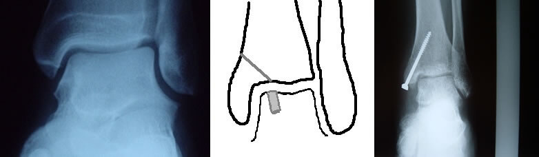 Oats Technique For Osteocartilaginal Defects Of The Ankle | CENTROKINETIC