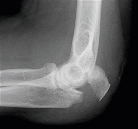 Surgical Treatment Of Olecrane Fracture | CENTROKINETIC