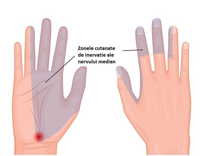 Carpian Tunnel Syndrome Treatment | CENTROKINETIC