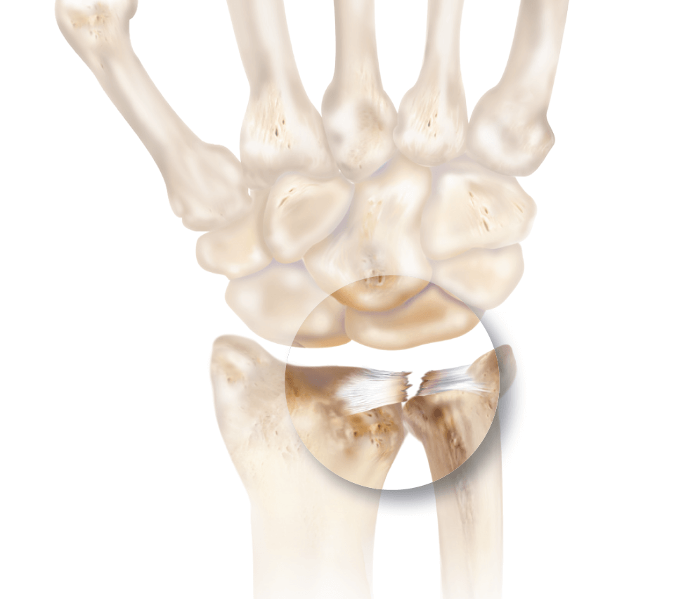 Reconstruction Of The Ulnar Triangular Fibrocartilagin Complex ...
