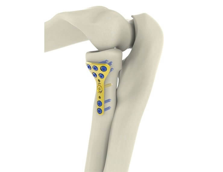 Surgical Treatment Of Radial Head Fracture | CENTROKINETIC