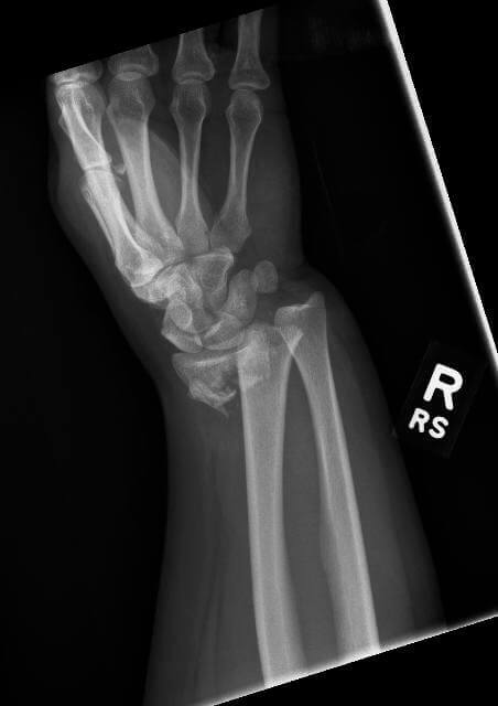 Surgical Treatment Of Radius Distal Epiphysis Fracture | CENTROKINETIC