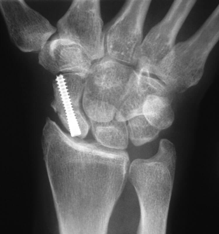Surgical Treatment Of Scafoid Fracture | CENTROKINETIC