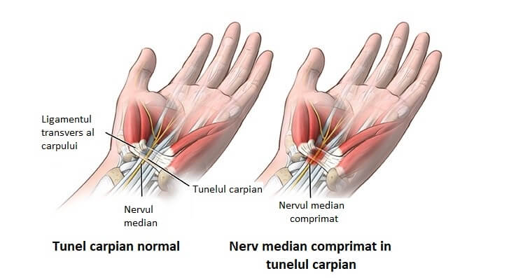 Carpian Tunnel Syndrome Treatment | CENTROKINETIC