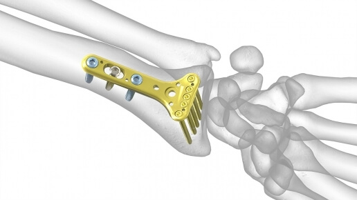 Surgical Treatment Of Radius Distal Epiphysis Fracture | CENTROKINETIC