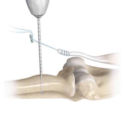 Course Of Distal Reinsertion Of The Biceps Brahial Muscle | CENTROKINETIC