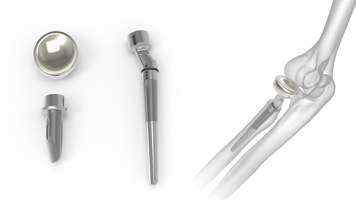 Surgical Treatment Of Radial Head Fracture | CENTROKINETIC