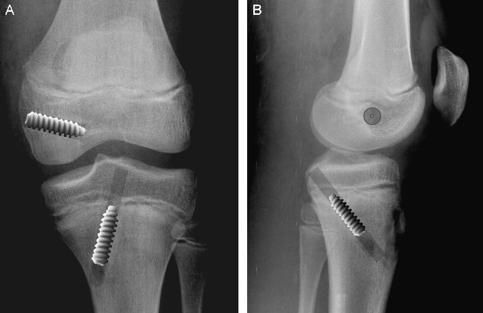 Rear Cross Link Reconstruction | CENTROKINETIC