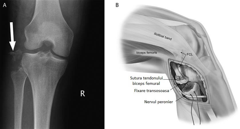 Reconstruction Of The Postero-External Knee Area | CENTROKINETIC