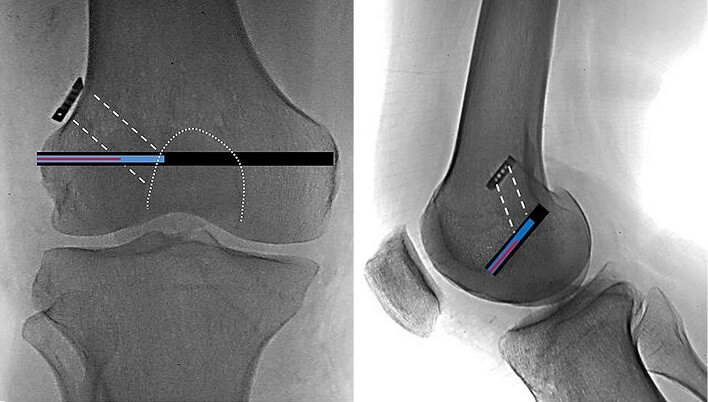 Reconstruction Of The Previous Crossover Ligament | CENTROKINETIC