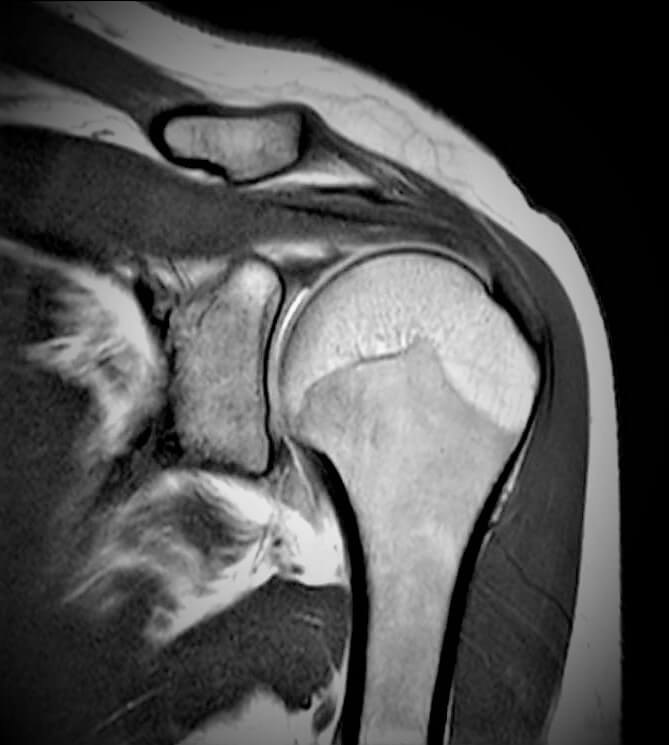 Treatment Of Subacromial Decompression | CENTROKINETIC