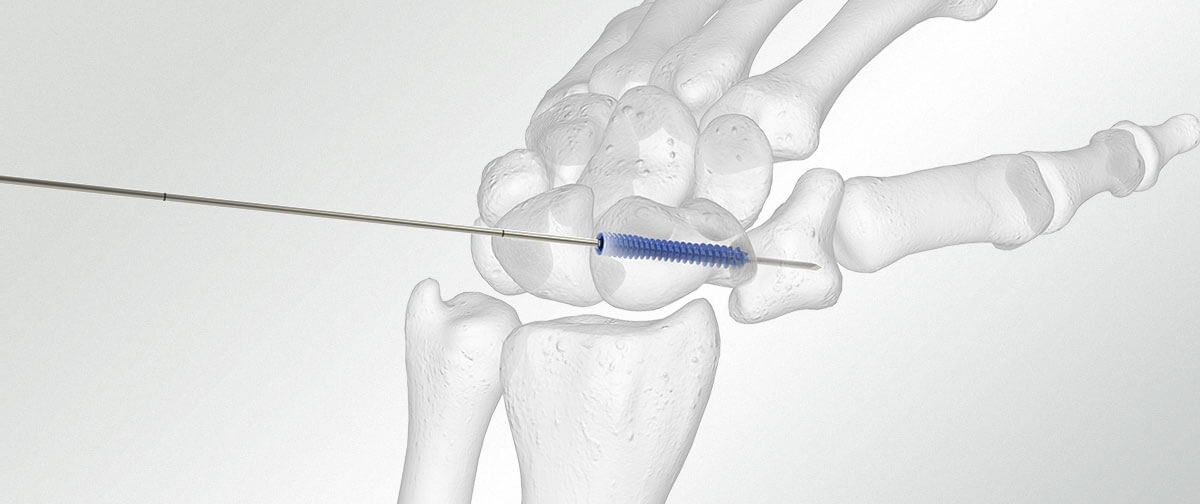 Cura chirurgicala a fracturii de scafoid | CENTROKINETIC