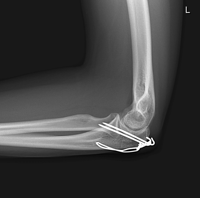 Cura chirurgicala a fracturii de olecran | CENTROKINETIC