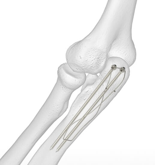 Cura chirurgicala a fracturii de olecran | CENTROKINETIC