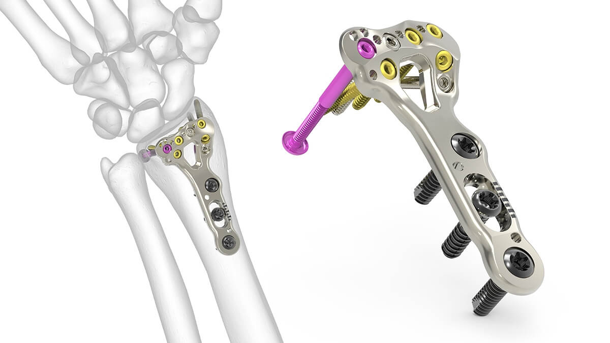 Cura chirurgicala a fracturii de radius | CENTROKINETIC