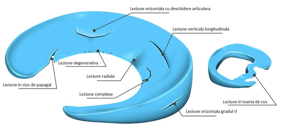 TRATAMENTUL LEZIUNILOR MENISCALE | CENTROKINETIC