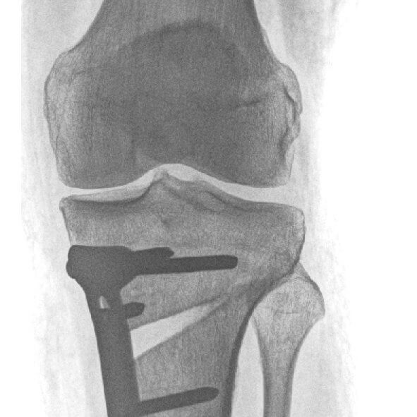 OSTEOTOMIILE LA NIVELUL GENUNCHIULUI| CENTROKINETIC