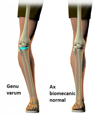 OSTEOTOMIILE LA NIVELUL GENUNCHIULUI| CENTROKINETIC