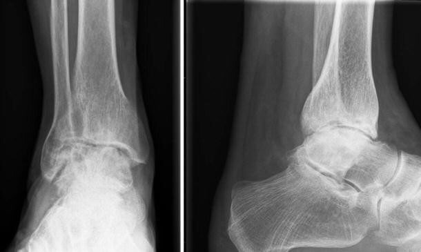 ARTRODEZA ARTROSCOPICA DE GLEZNA | CENTROKINETIC