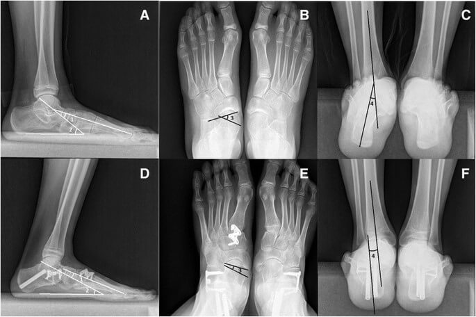 OSTEOTOMIILE DE CALCANEU IN PICIORUL PLAT VALG| CENTROKINETIC