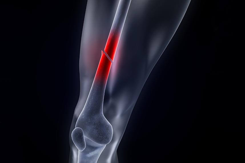 Fractura de femur: ce este, cauze, simptome, tratament