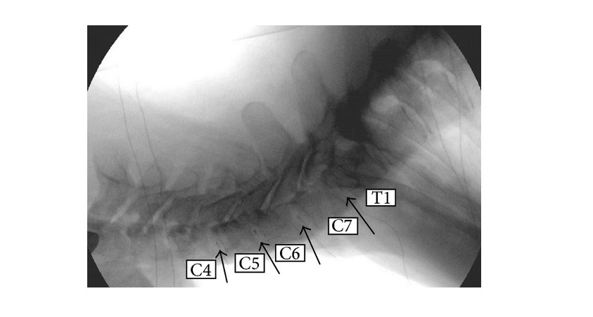 Elongatii manuale: Cum modifica presiunea coloanei cervicale