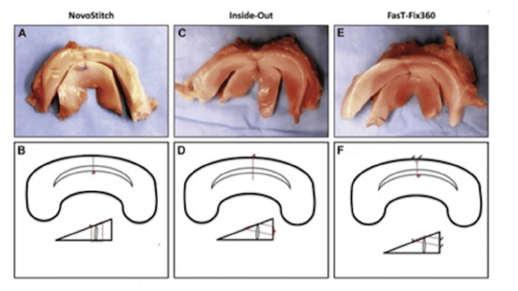Reabilitare dupa sutura de menisc | CENTROKINETIC