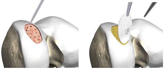 TRATAMENTUL LEZIUNILOR DE CARTILAJ ARTICULAR | CENTROKINETIC