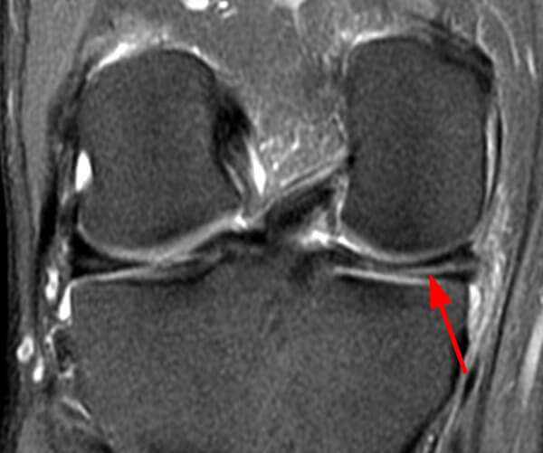 TRATAMENTUL LEZIUNILOR MENISCALE | CENTROKINETIC
