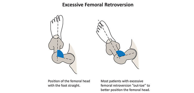 Coxa-retrotorsa – torsiune femurala externa | CENTROKINETIC